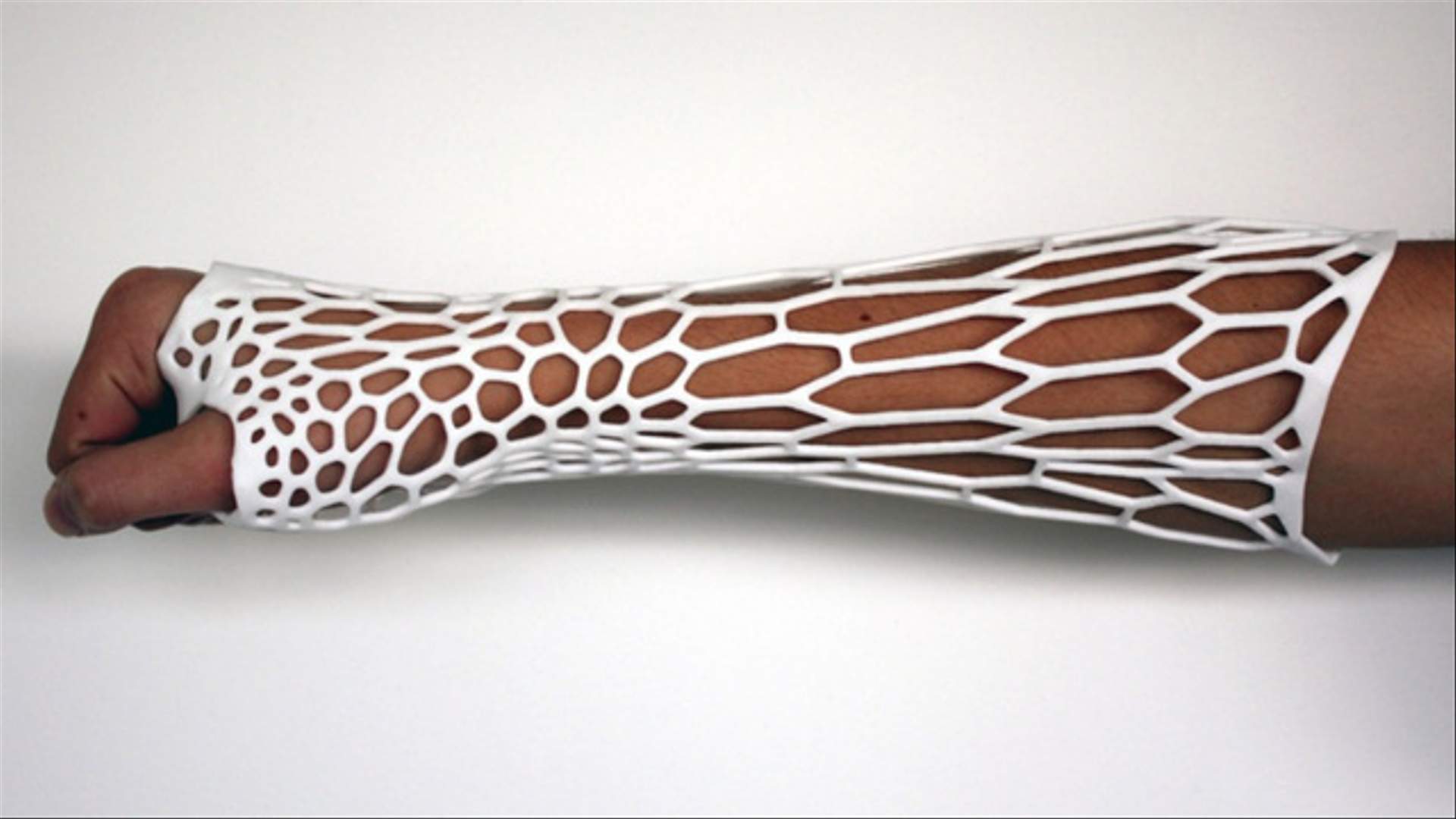 3D Printing Upgrades the Humble Plaster Cast - Concrete Playground